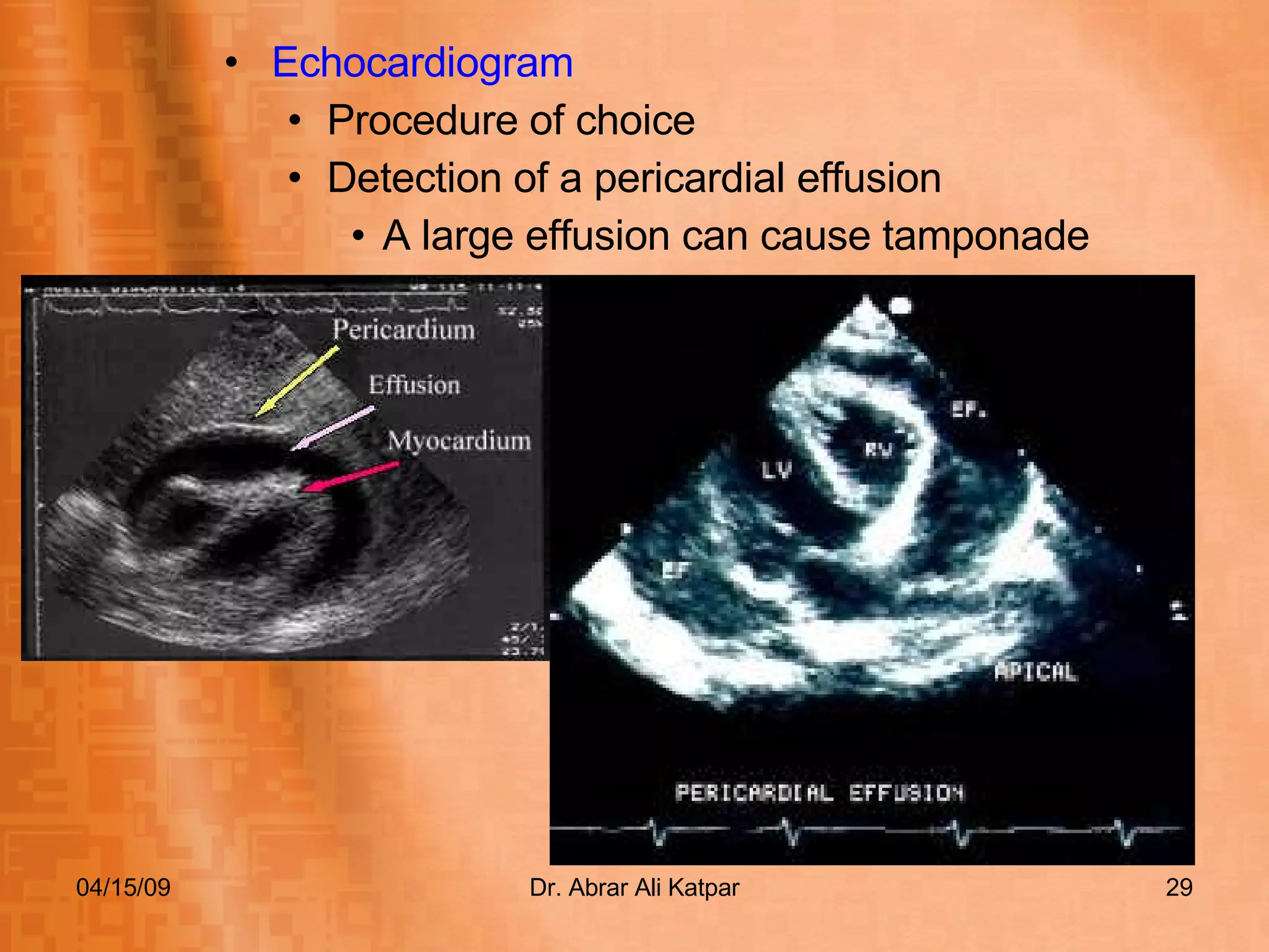 Uremic Pericarditis | PPT