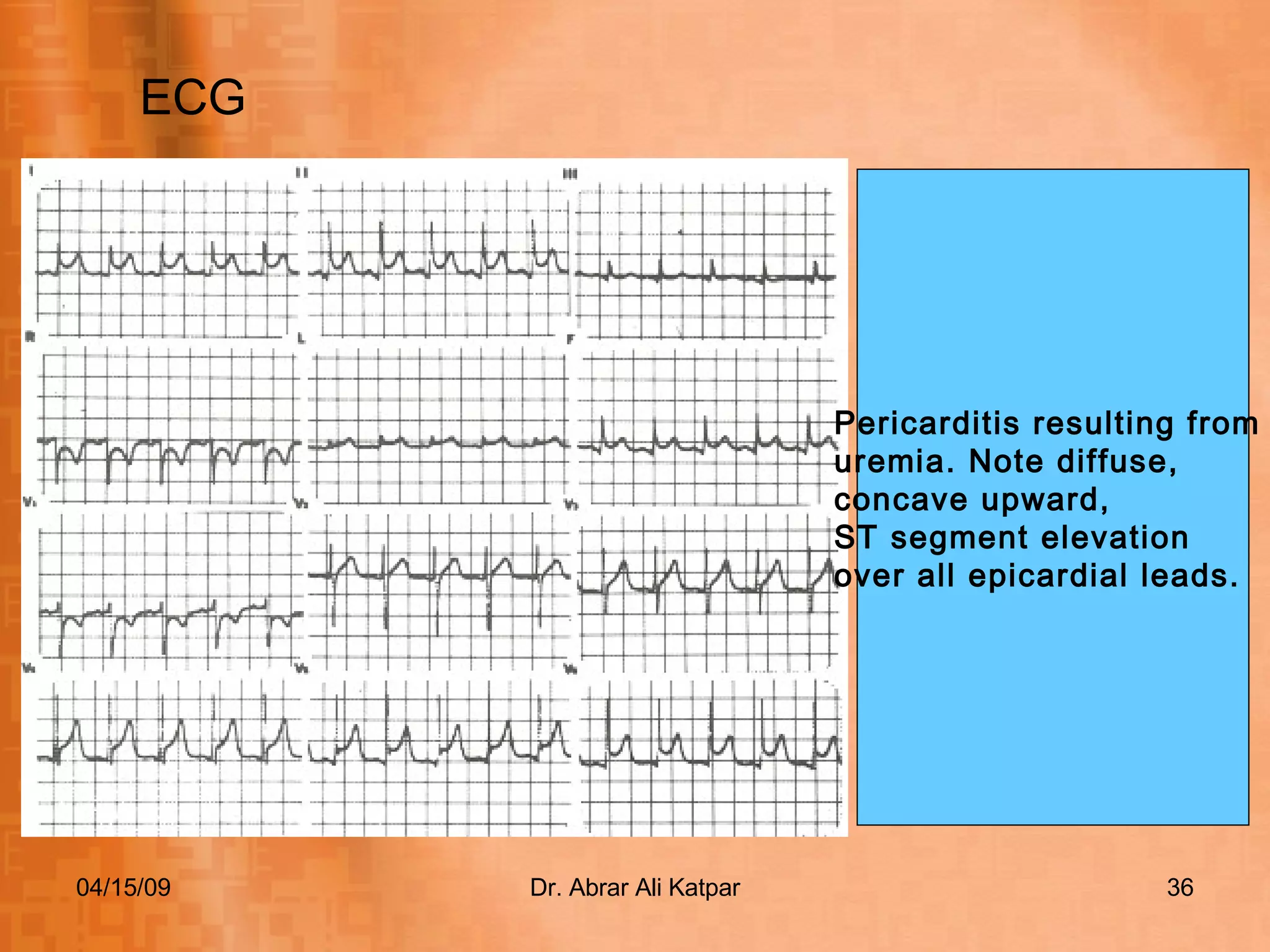 Uremic Pericarditis | PPT