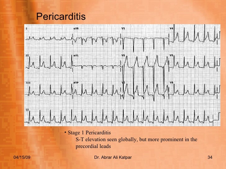 Uremic Pericarditis