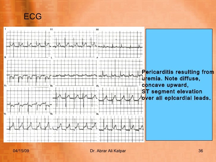 Uremic Pericarditis