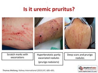 Uremic Pruritis - Pathogenesis & Management - Dr. Gawad | PPT