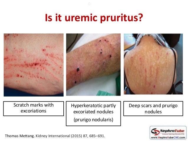 Uremic Pruritis - Pathogenesis & Management