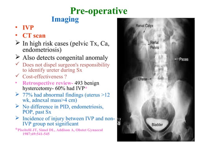 Ureteric Injury at Gynaecological Surgery | PPT | Reproductive Health ...