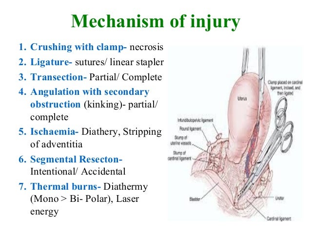 Ureteric Injury at Gynaecological Surgery