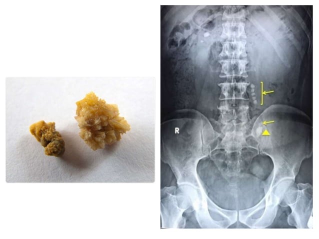 Ureter | PPTX | Death, Injury, or Military Conflict | Sensitive Topics