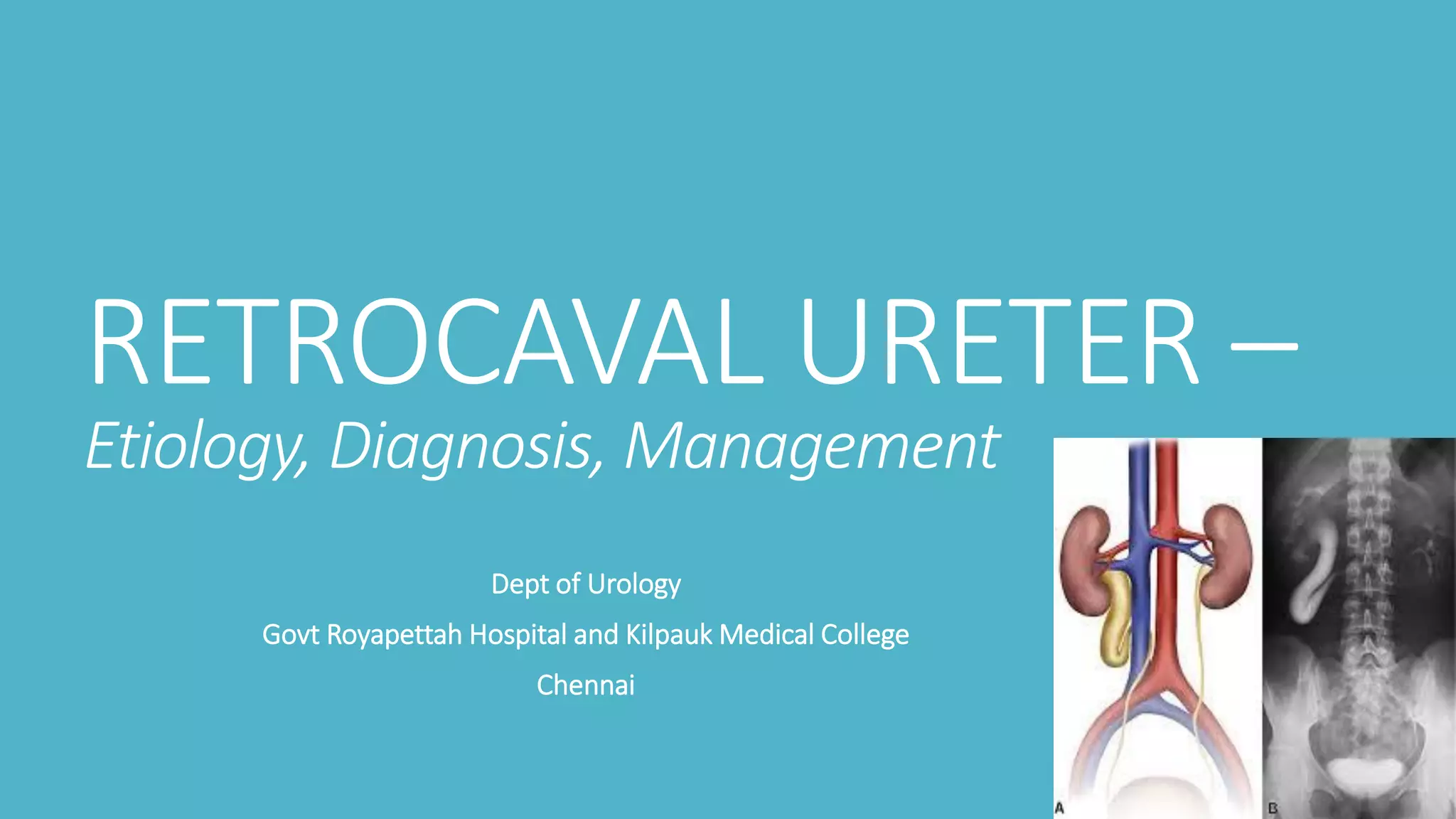 retrocaval ureter | PDF