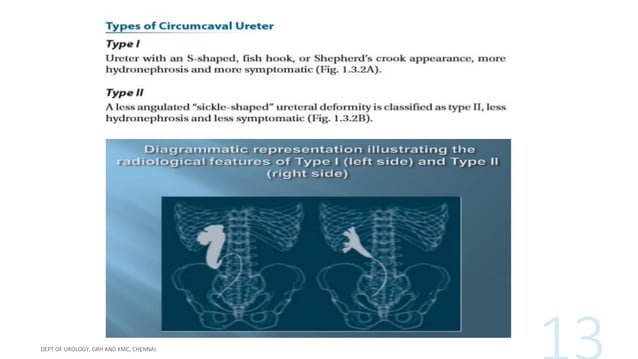 retrocaval ureter | PDF