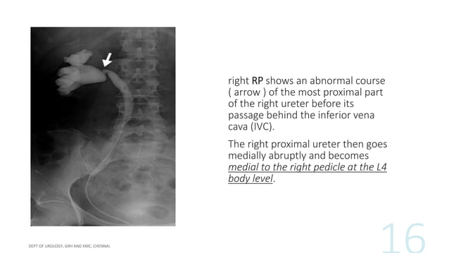 retrocaval ureter | PDF