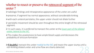 retrocaval ureter | PDF