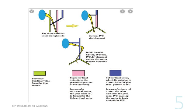 retrocaval ureter | PDF