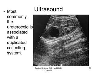 Ureterocele Ultrasound