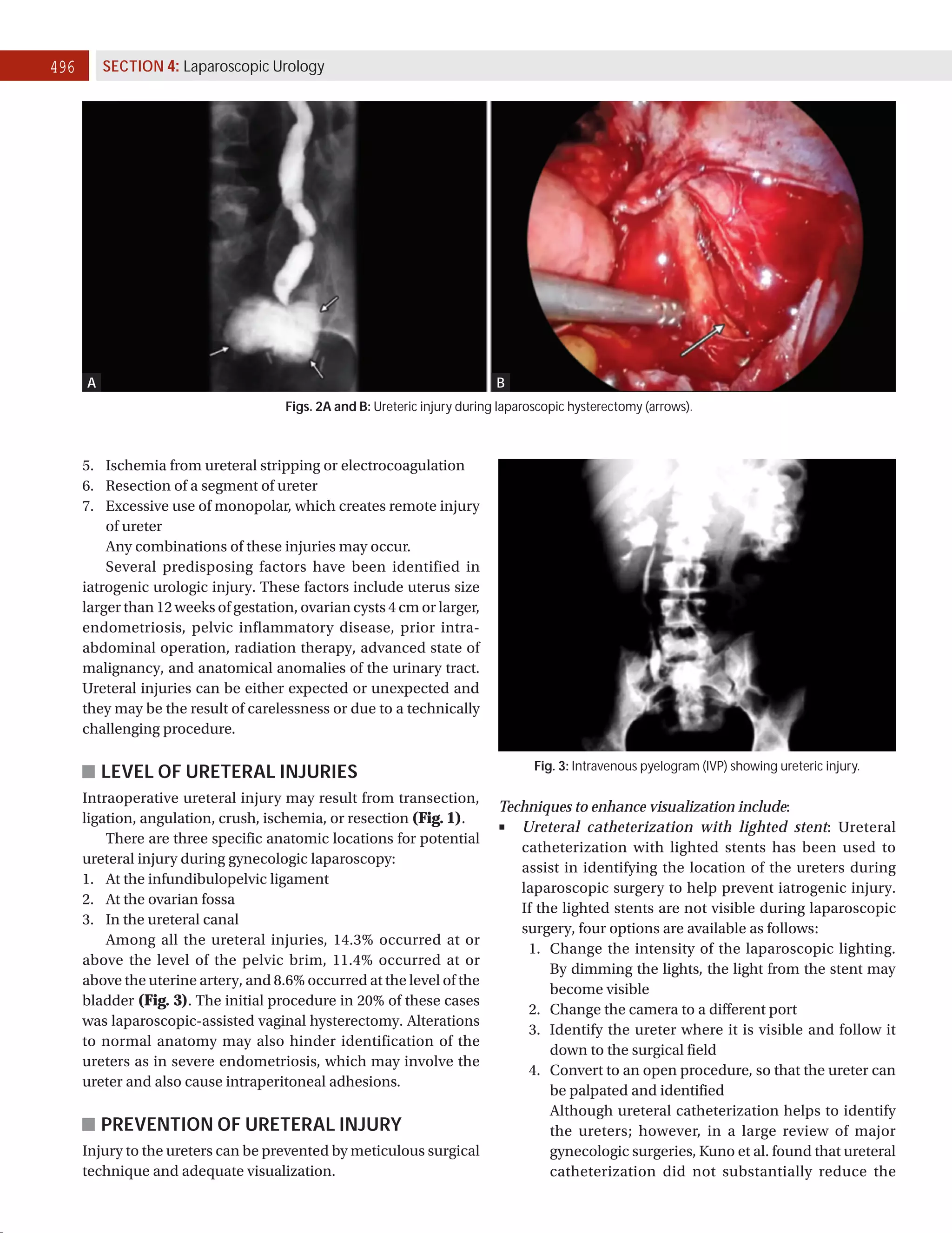 Ureteral Injury and Laparoscopy | PDF