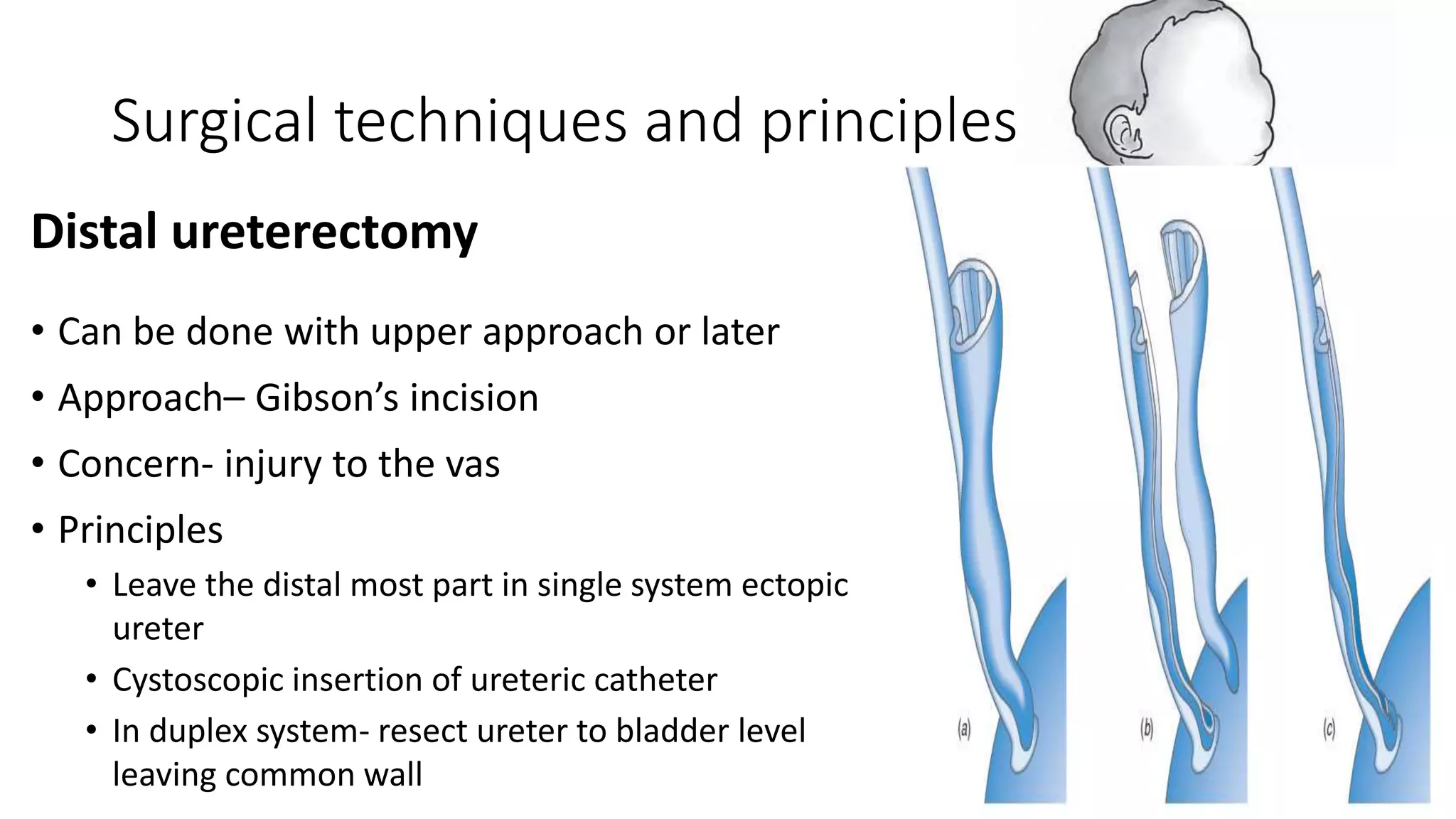 URETERAL ANOMALIES.pptx