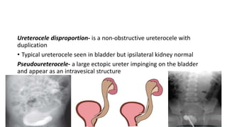 Ureteral Anomalies Pptx