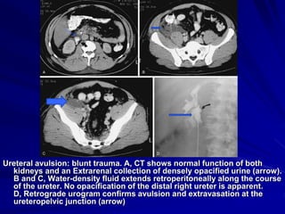 Ureteral injury) | PPT