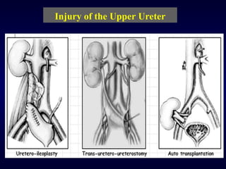 Ureteral Injury in gyne and obstetri.ppt