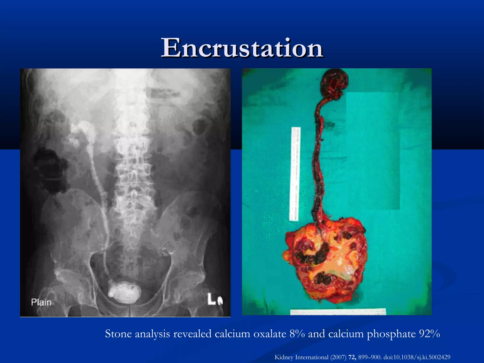 Ureteral stents for the Dx Radiologist | PPT
