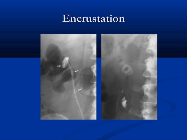 Encrustation