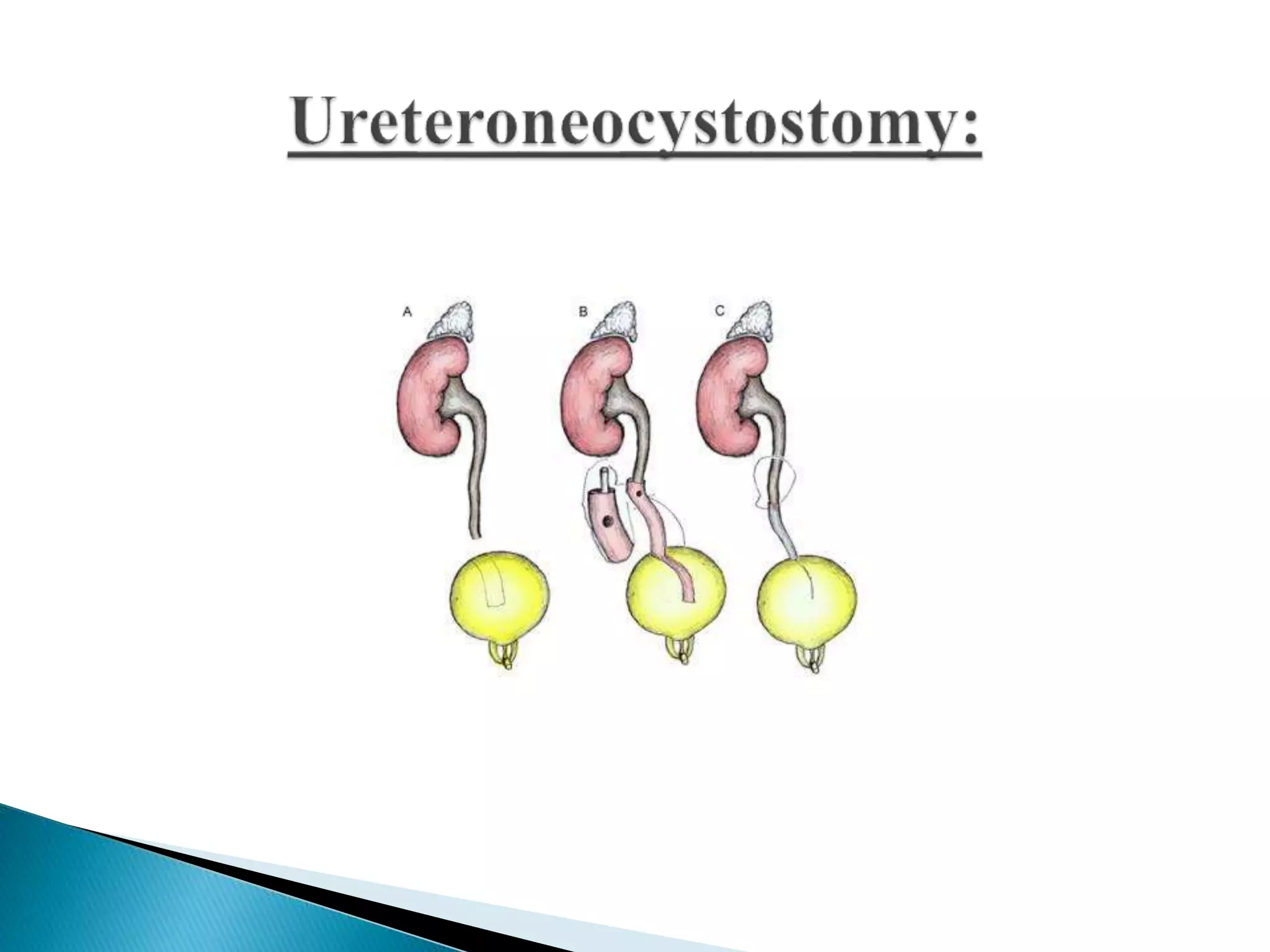 Ureteral stricture | PPTX