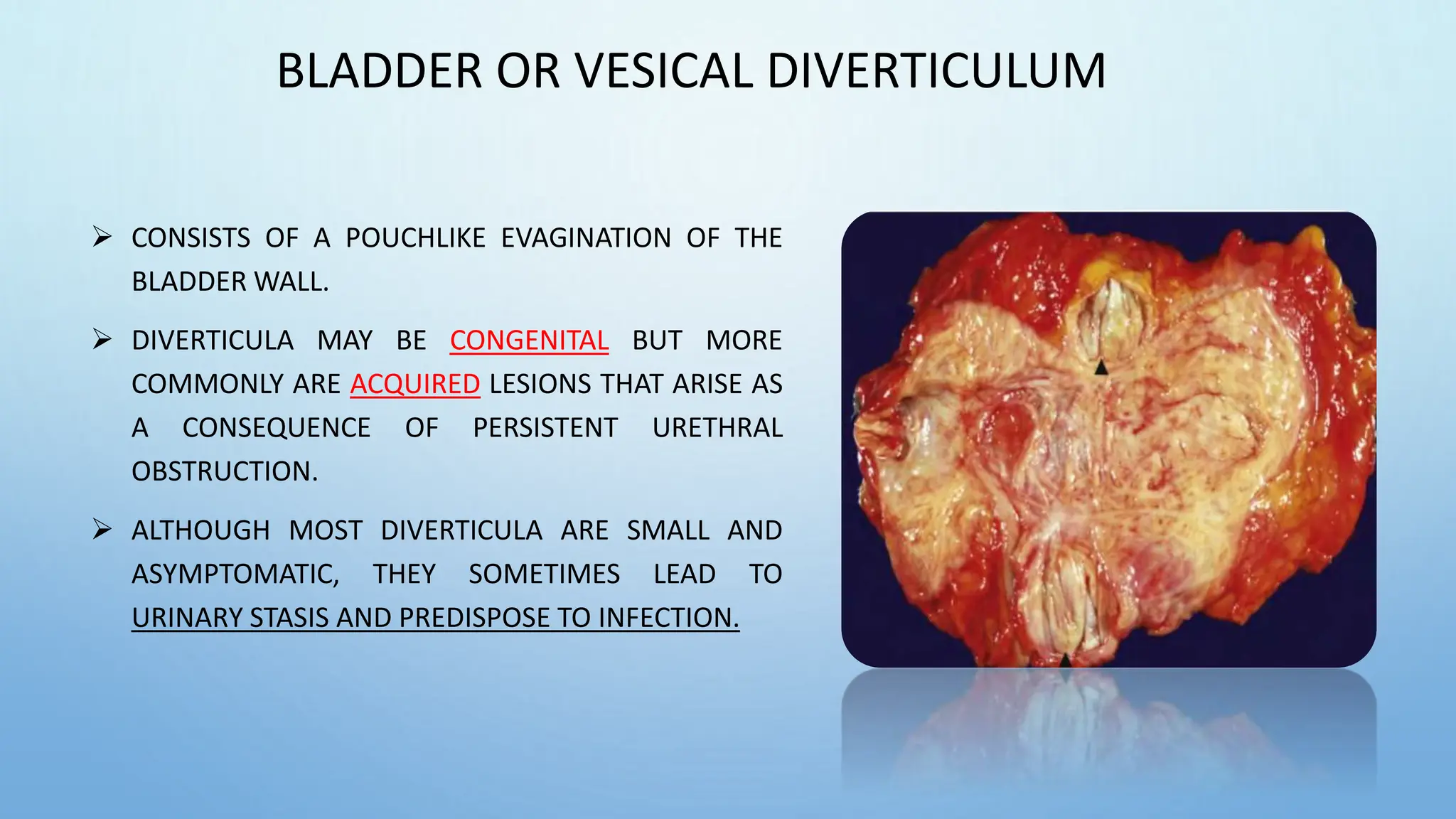 Ureter pathology and urinary bladder.pptx