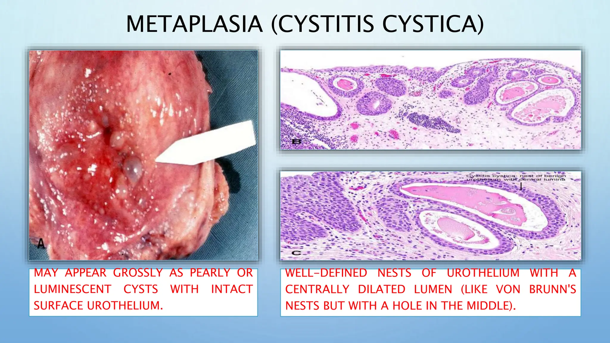 Ureter pathology and urinary bladder.pptx