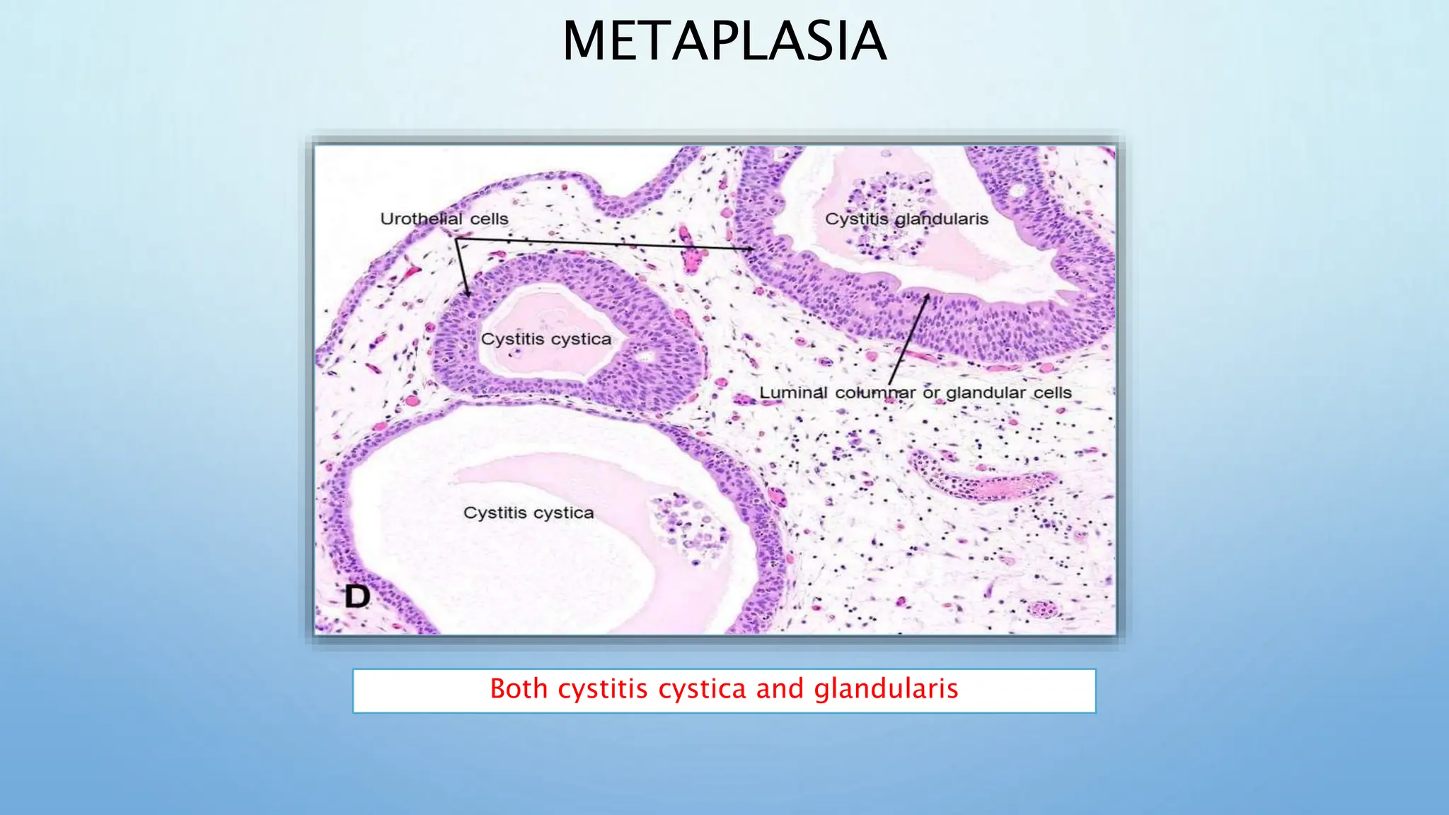 Ureter pathology and urinary bladder.pptx