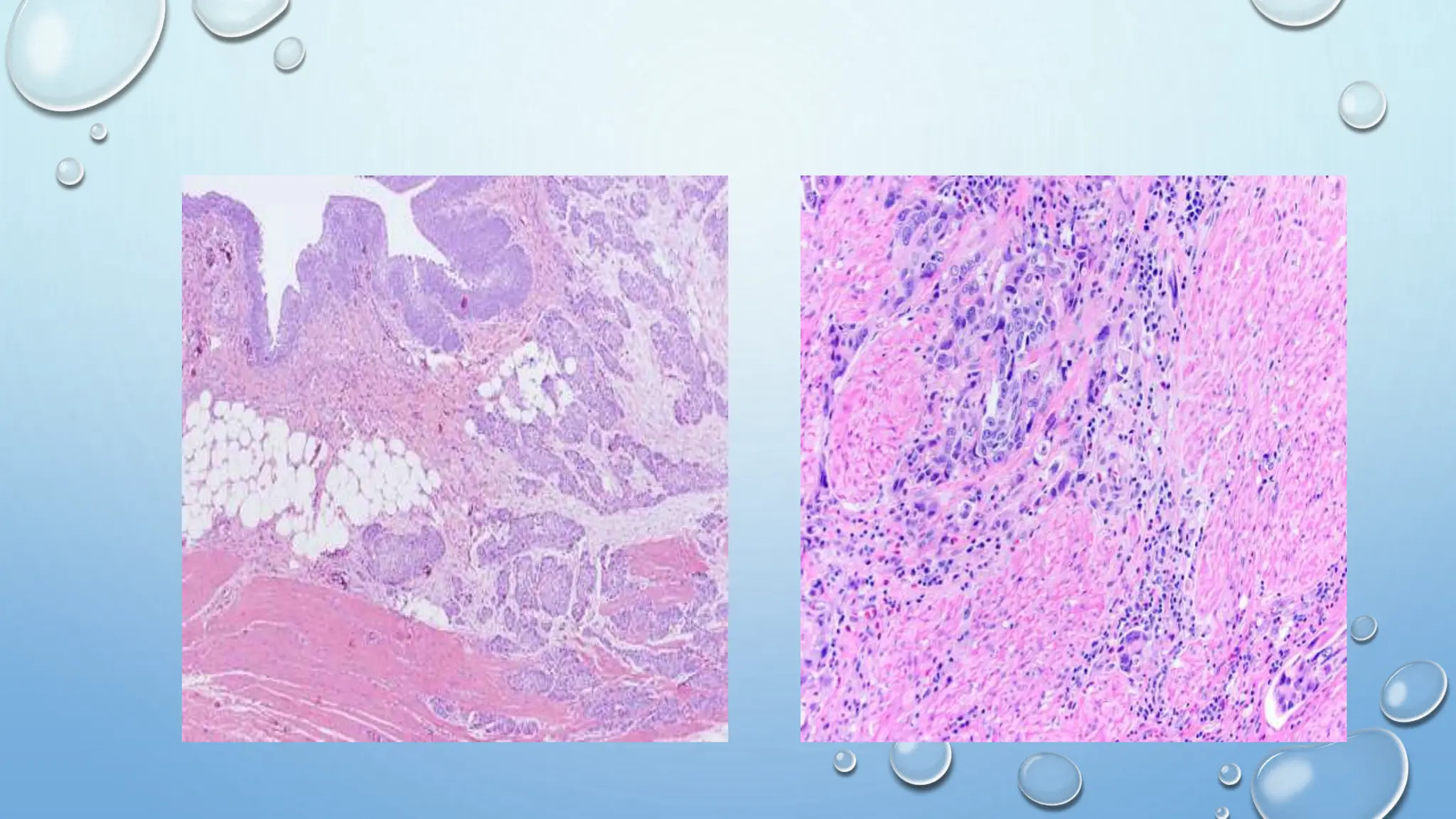 Ureter pathology and urinary bladder.pptx