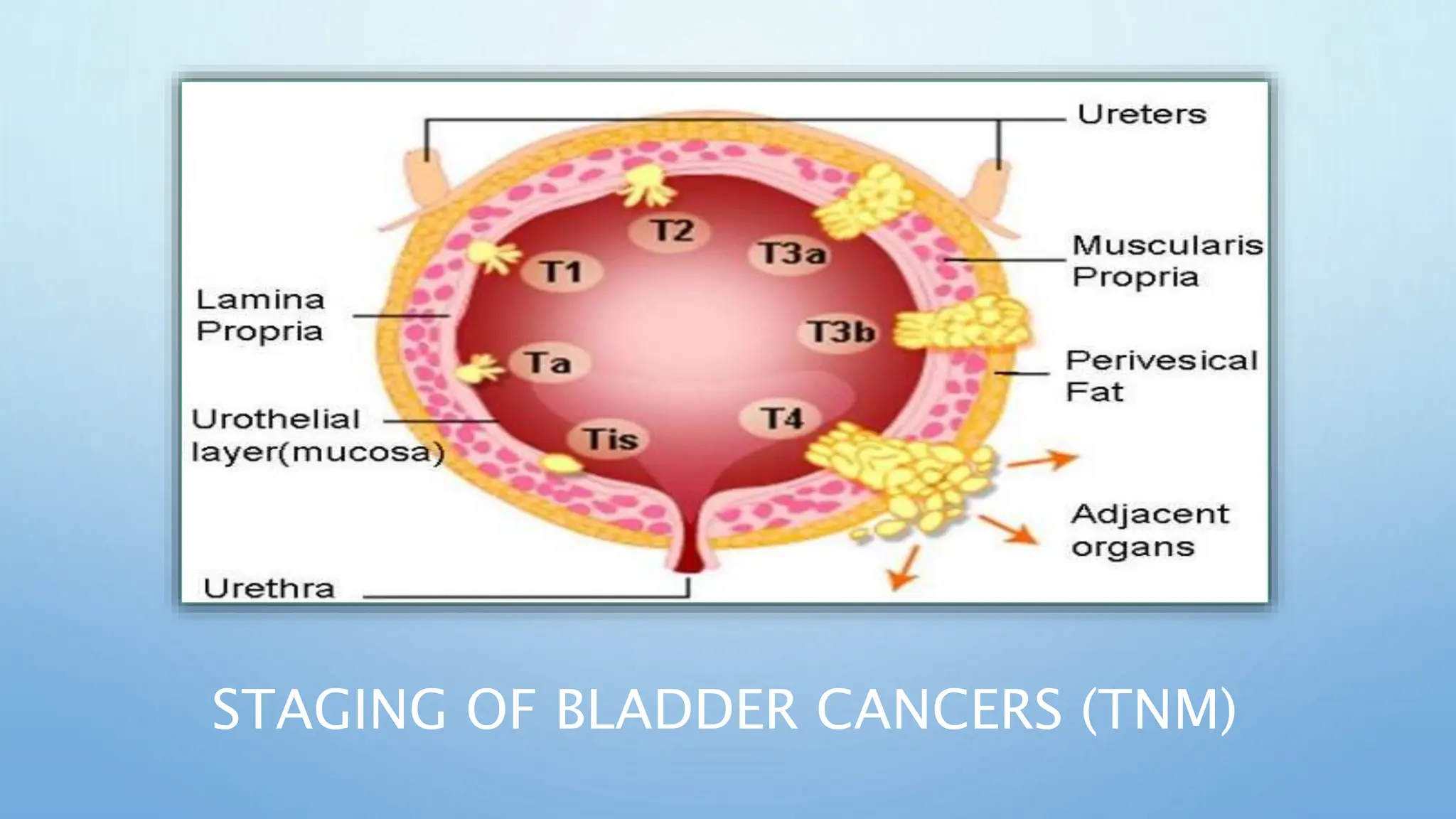 Ureter pathology and urinary bladder.pptx