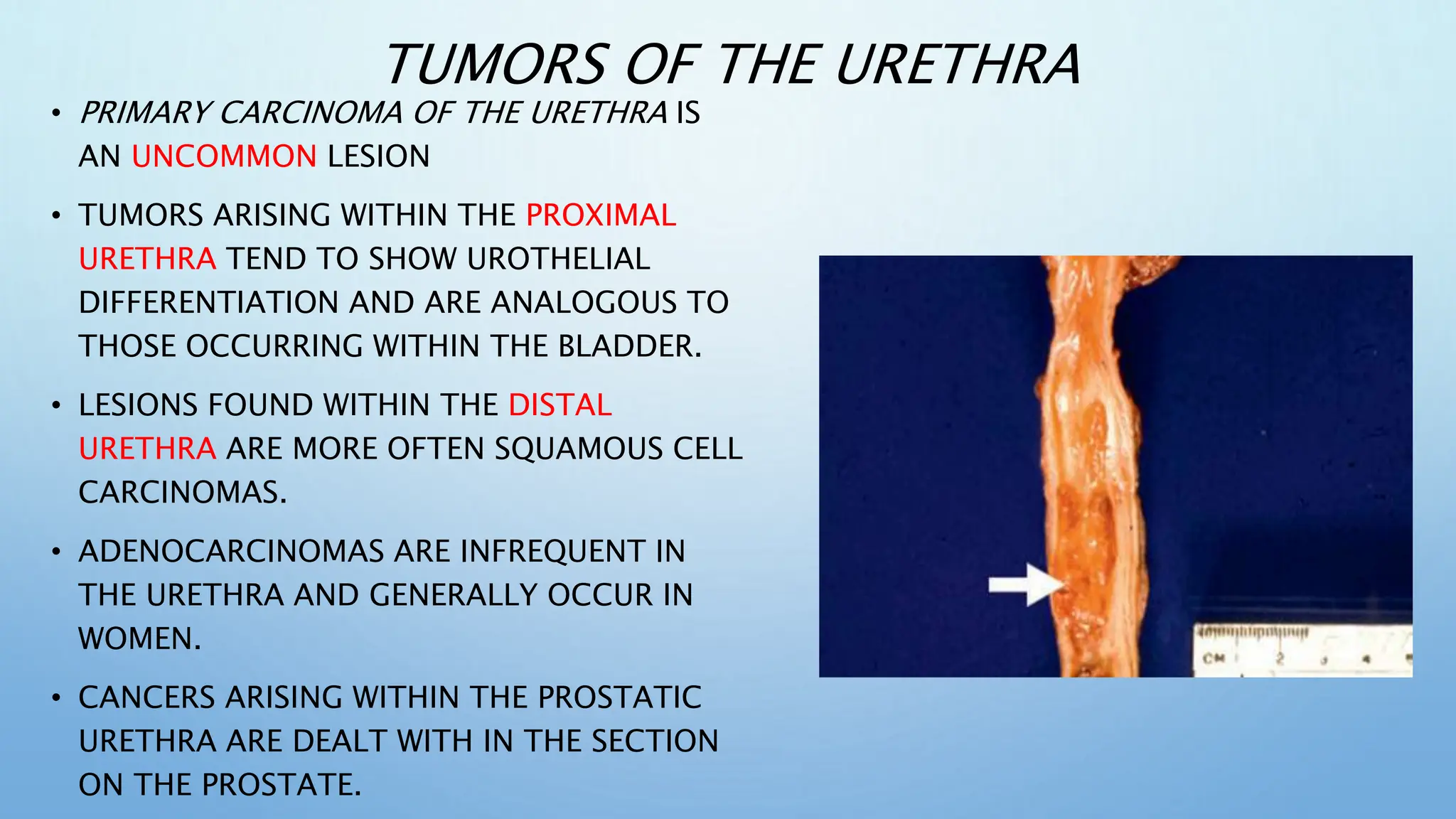 Ureter pathology and urinary bladder.pptx