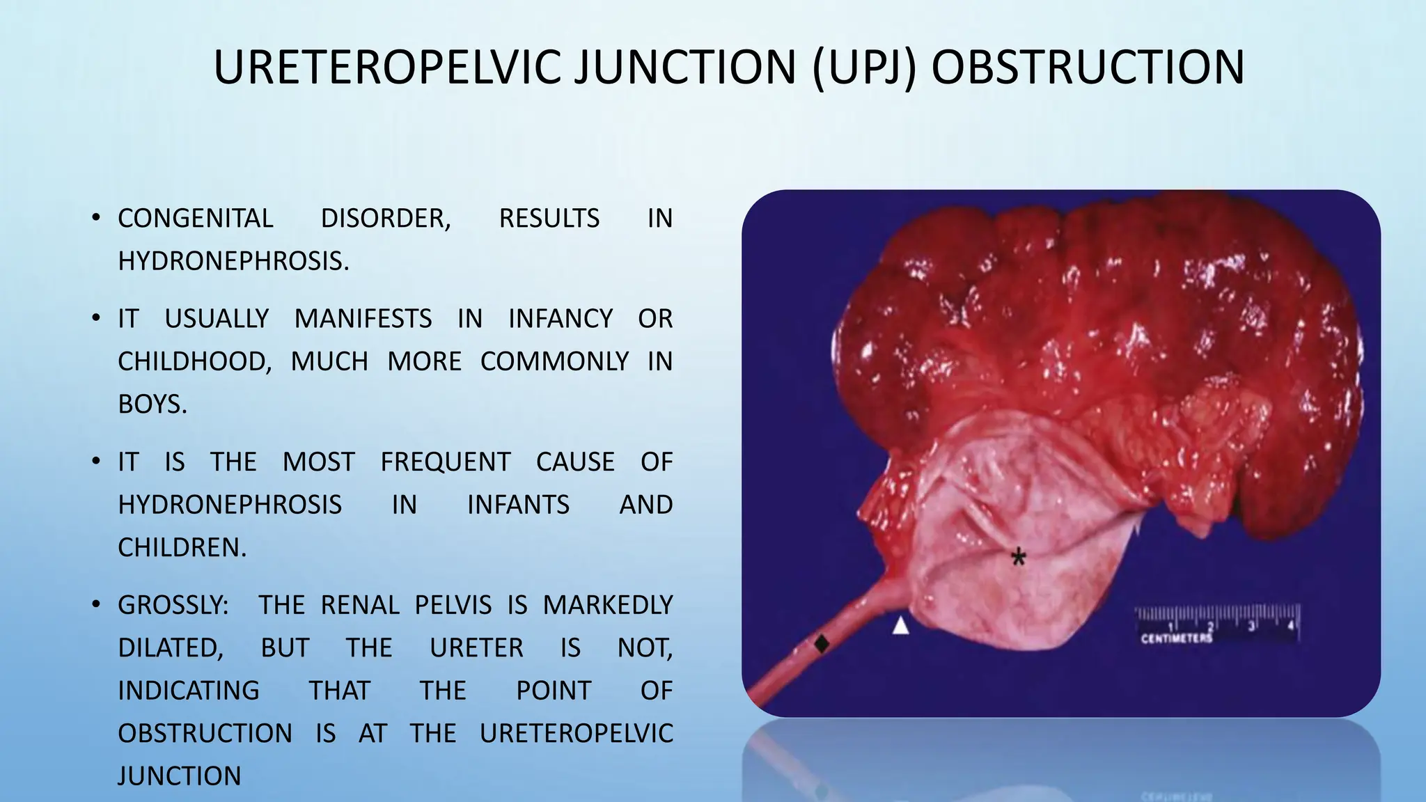 Ureter pathology and urinary bladder.pptx