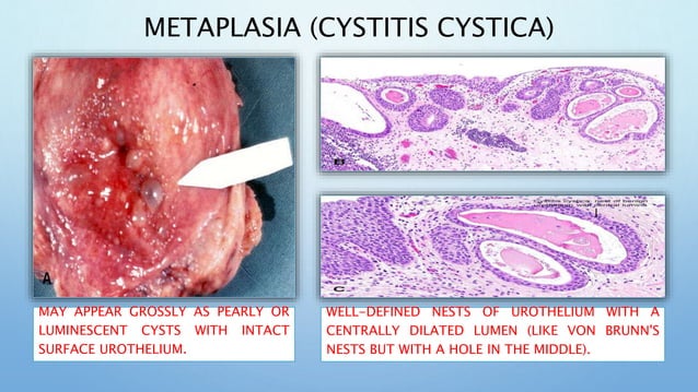 Ureter pathology and urinary bladder.pptx
