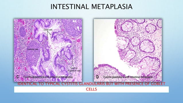 Ureter pathology and urinary bladder.pptx