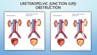Ureter pathology and urinary bladder.pptx