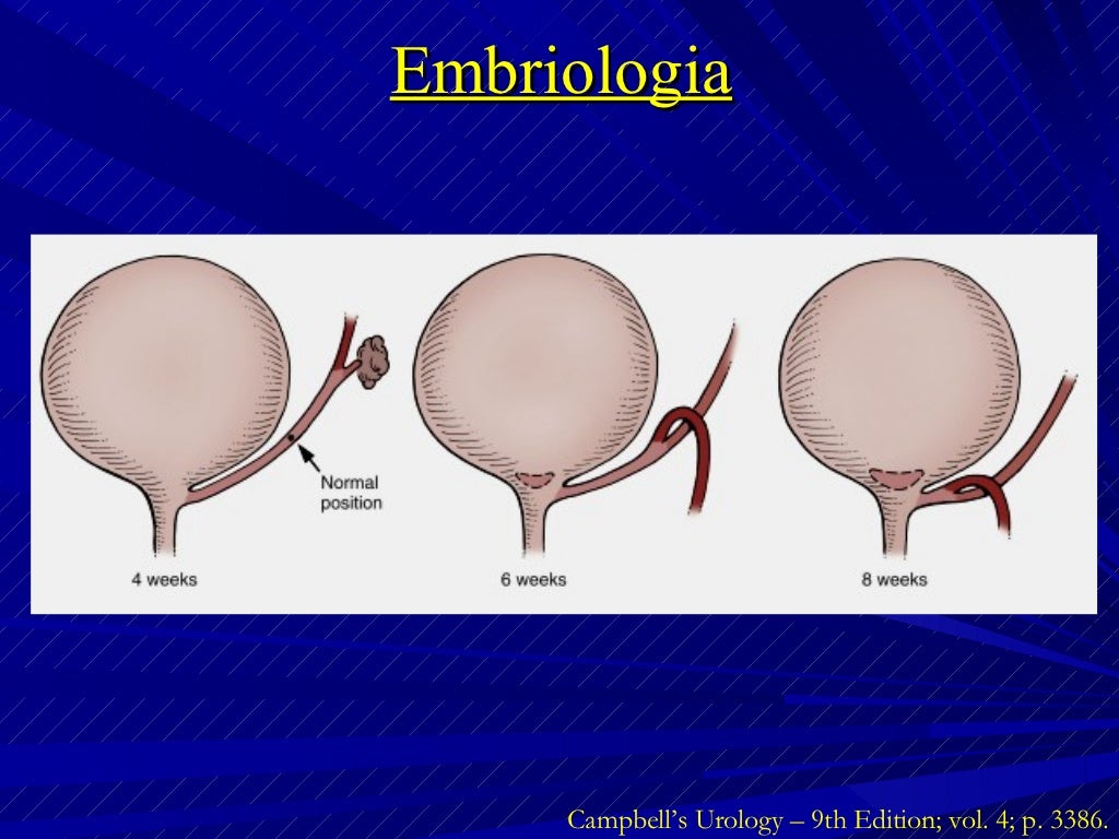 Ureter Ectópico e Ureterocele