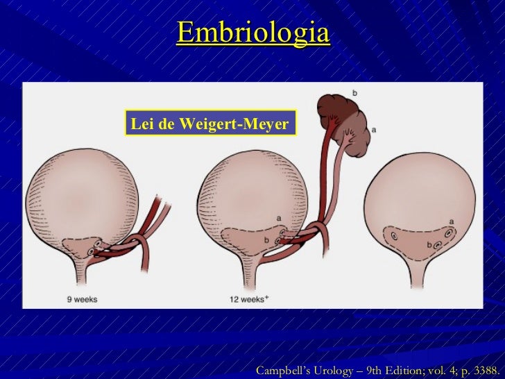 Ureter Ectópico e Ureterocele