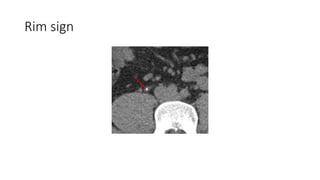 Ureteric colic.pptx