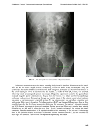 Ureteric endometriosis | PDF | Reproductive Health | Diseases and ...