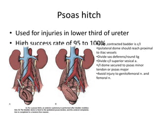 Ureteric injuries | PPT