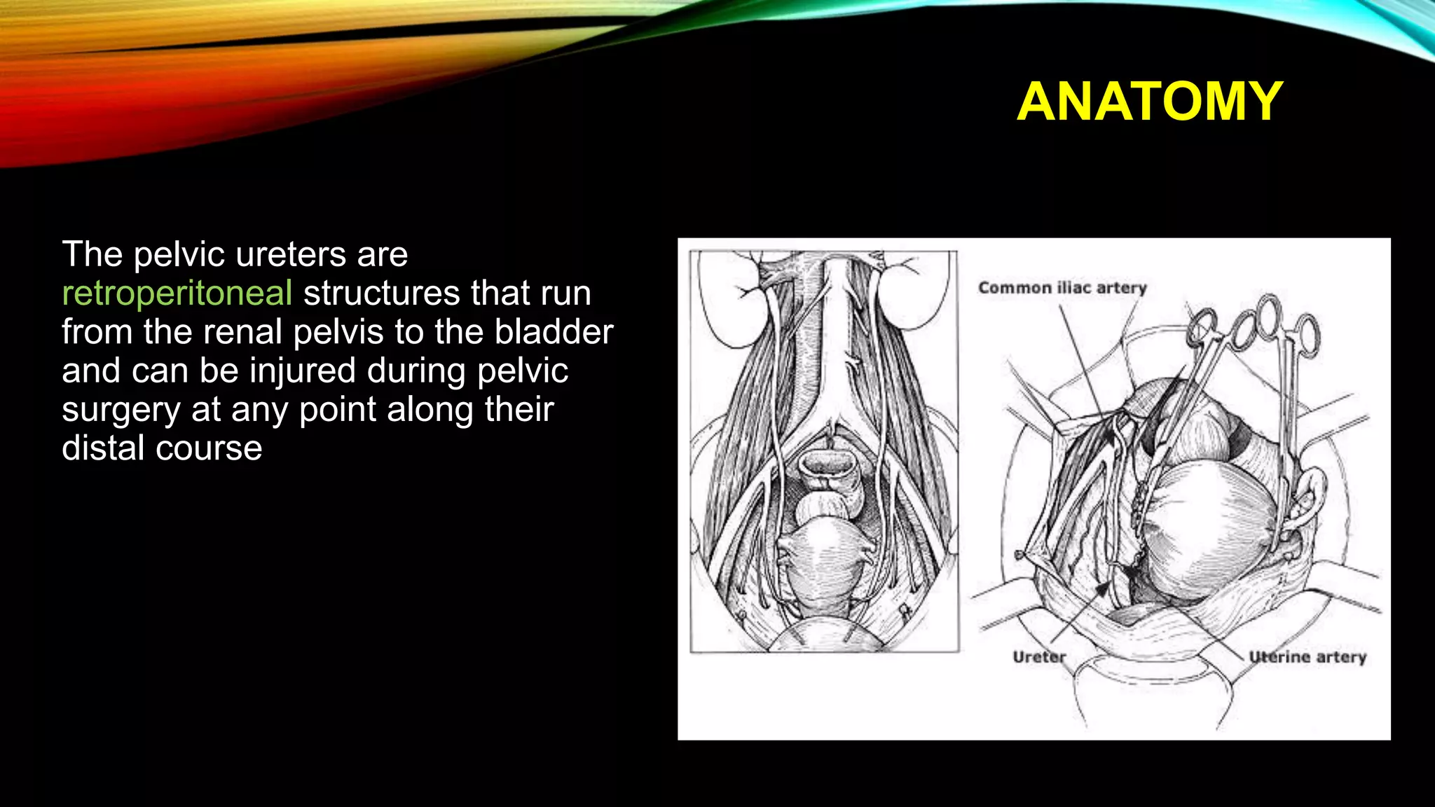 Ureteric injuries in gynecological surgeries | PPTX