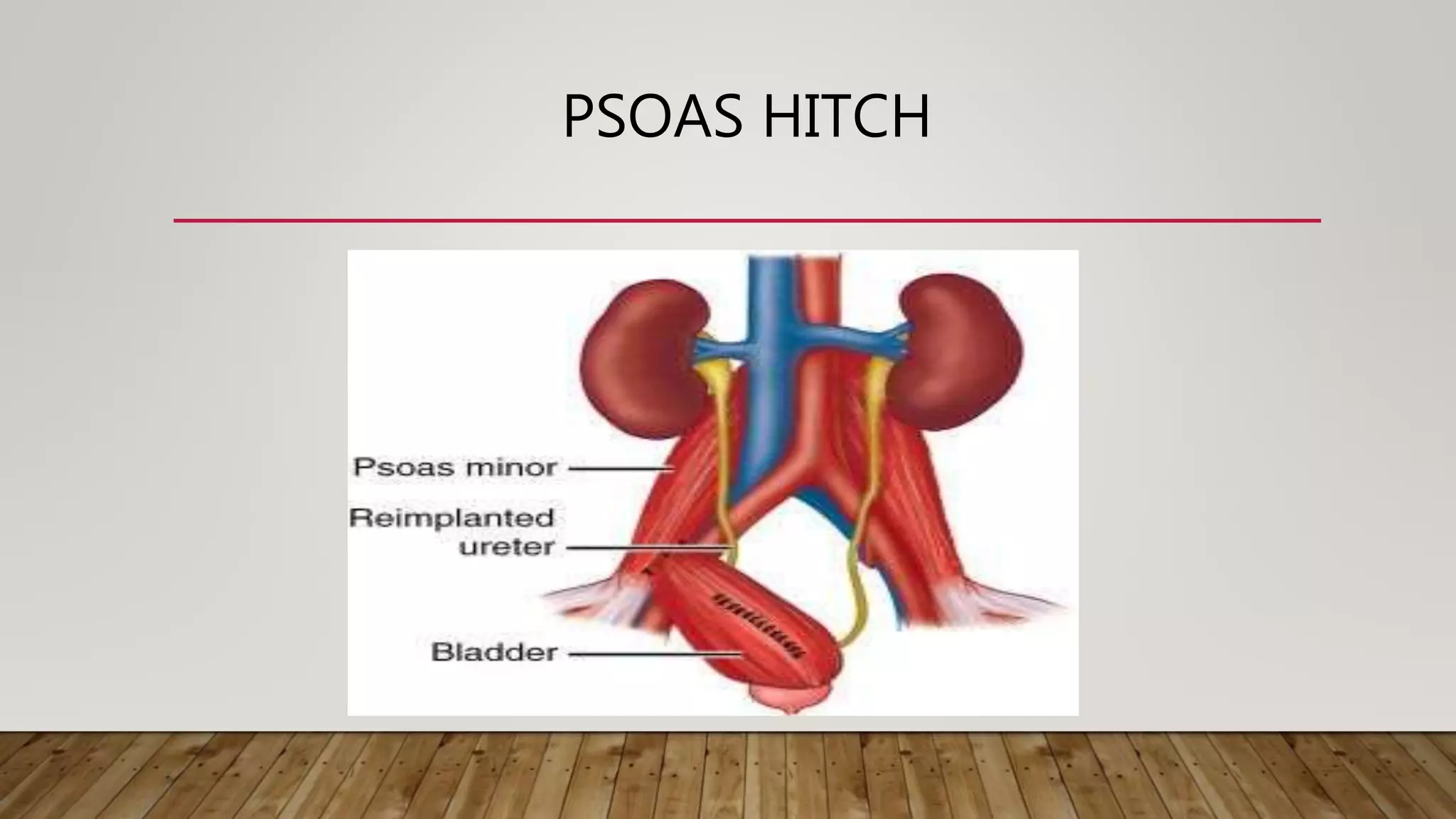 Ureteric injury | PPTX