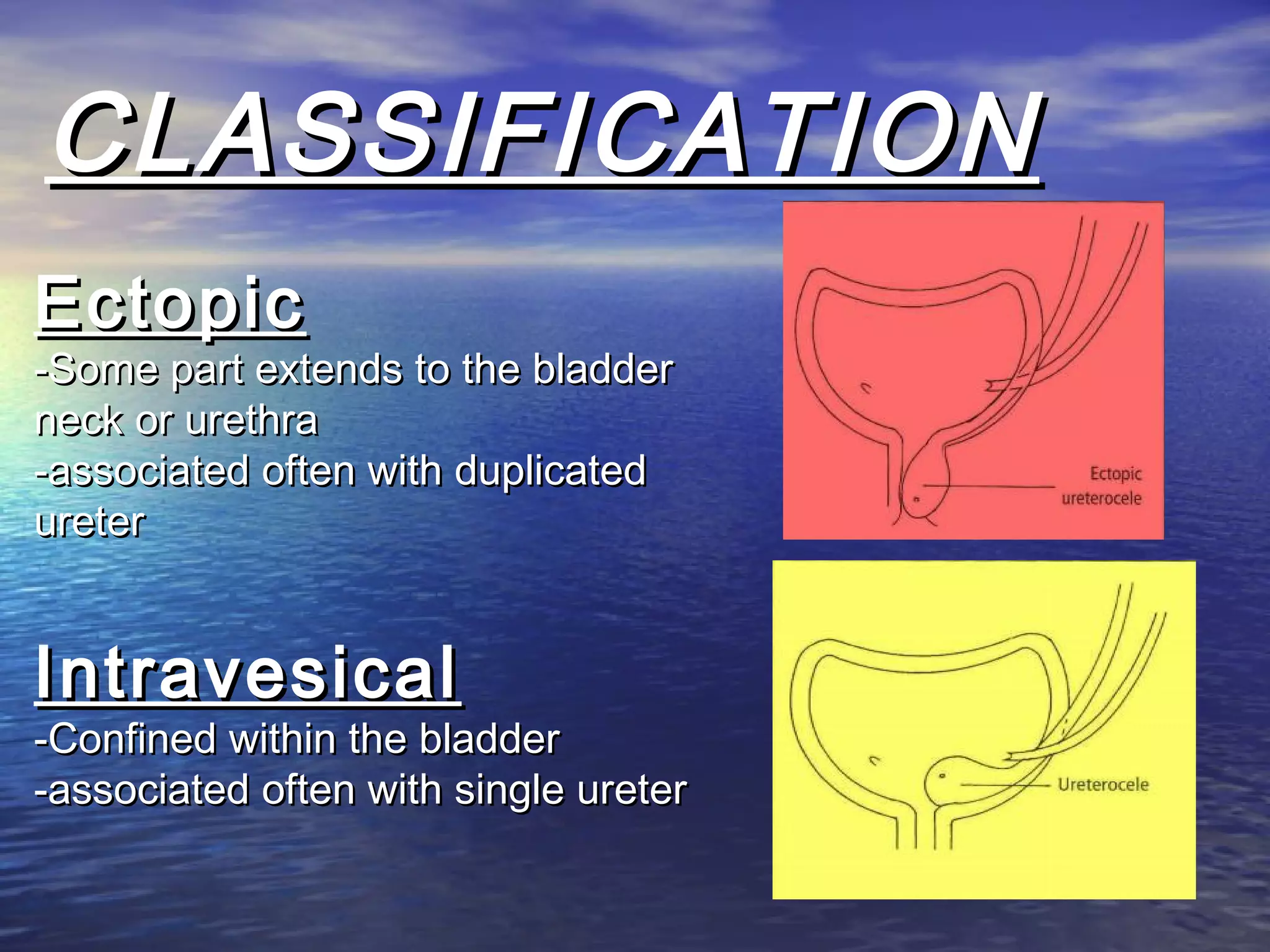 Ureterocele | PPT
