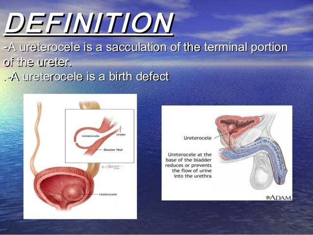 Ureterocele