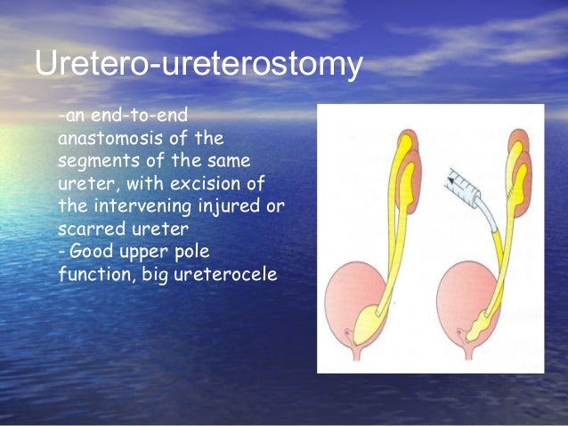 Ureterocele