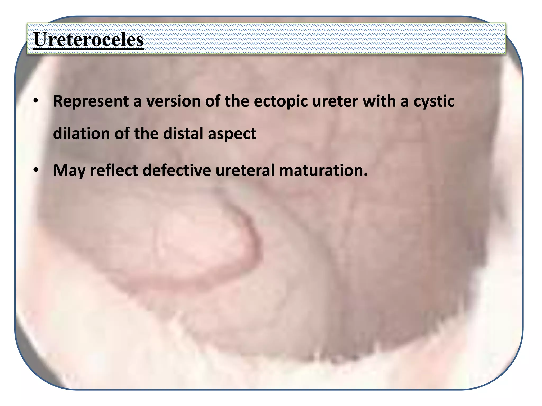 Ureterocele, | PPTX