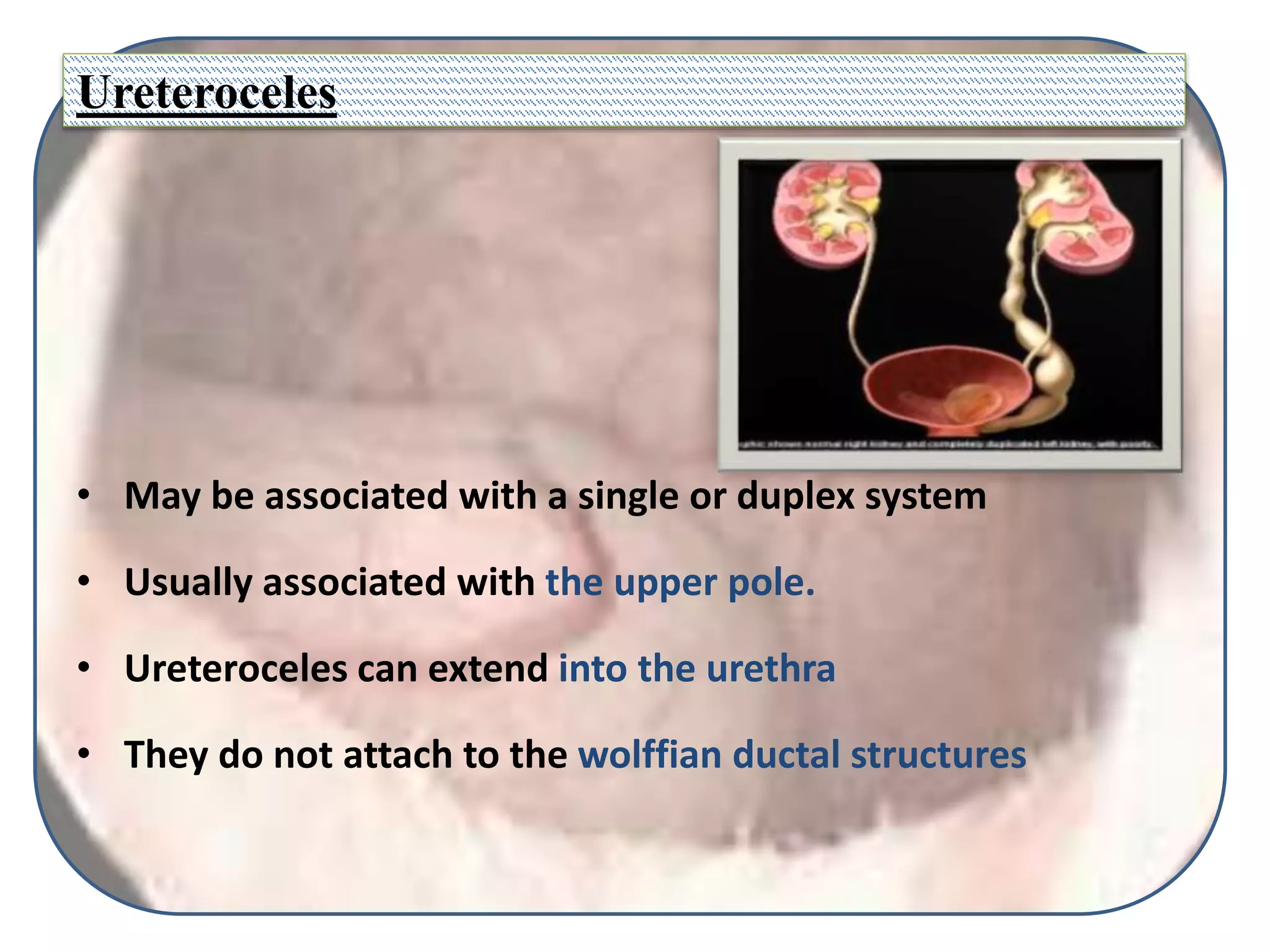 Ureterocele, | PPTX