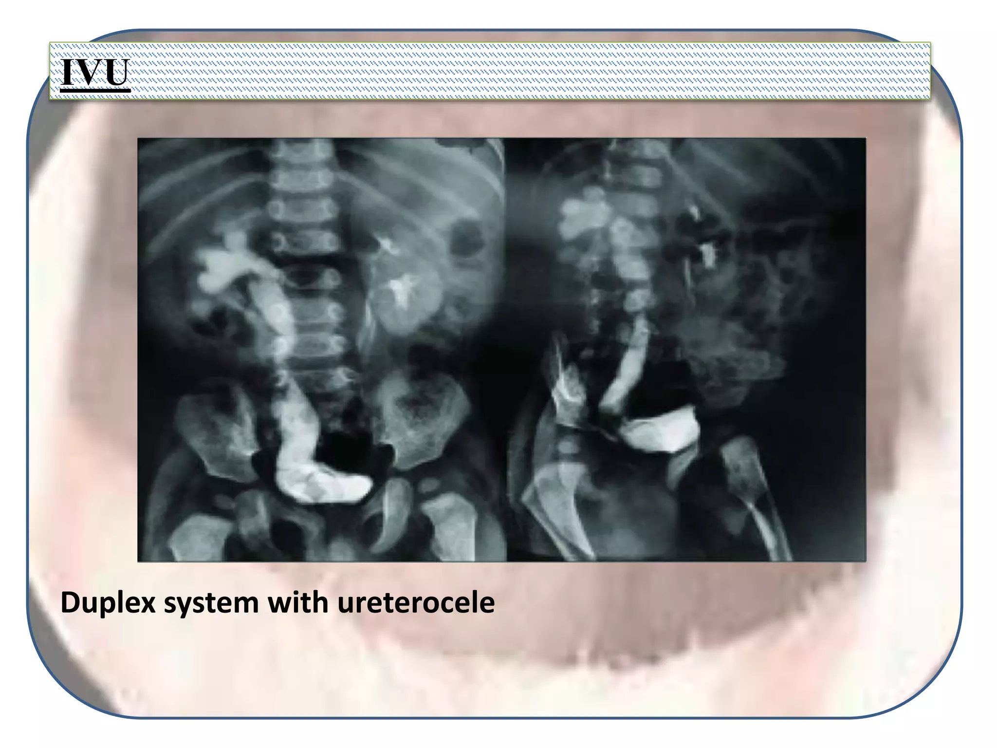 Ureterocele, | PPTX
