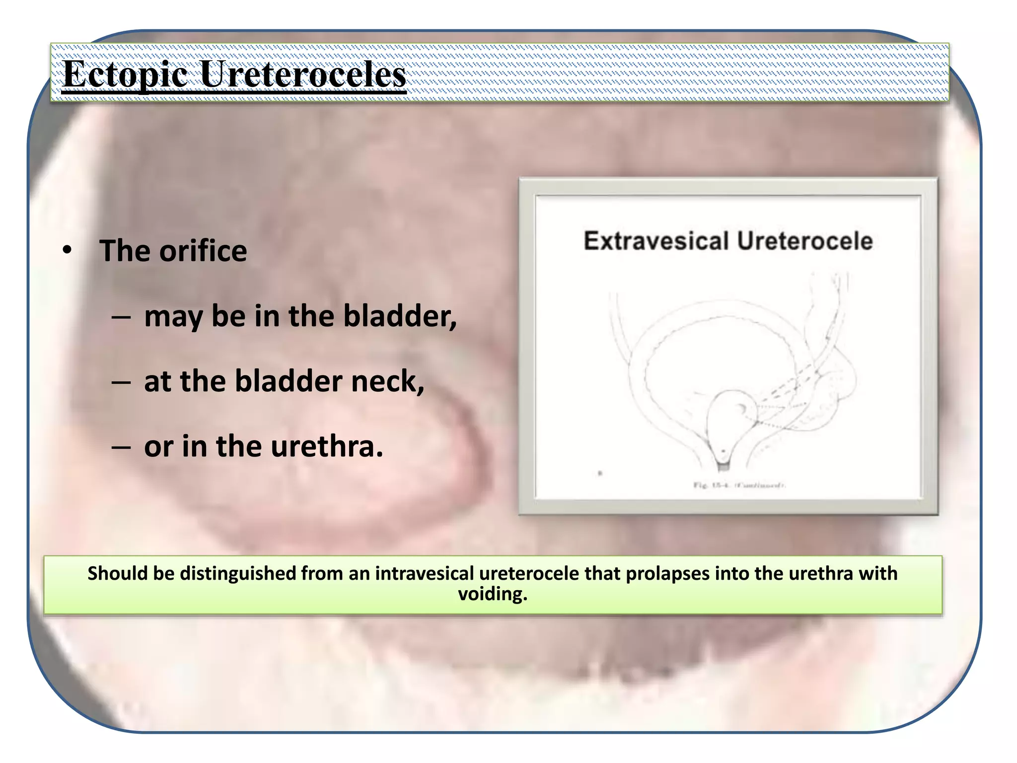 Ureterocele, | PPTX