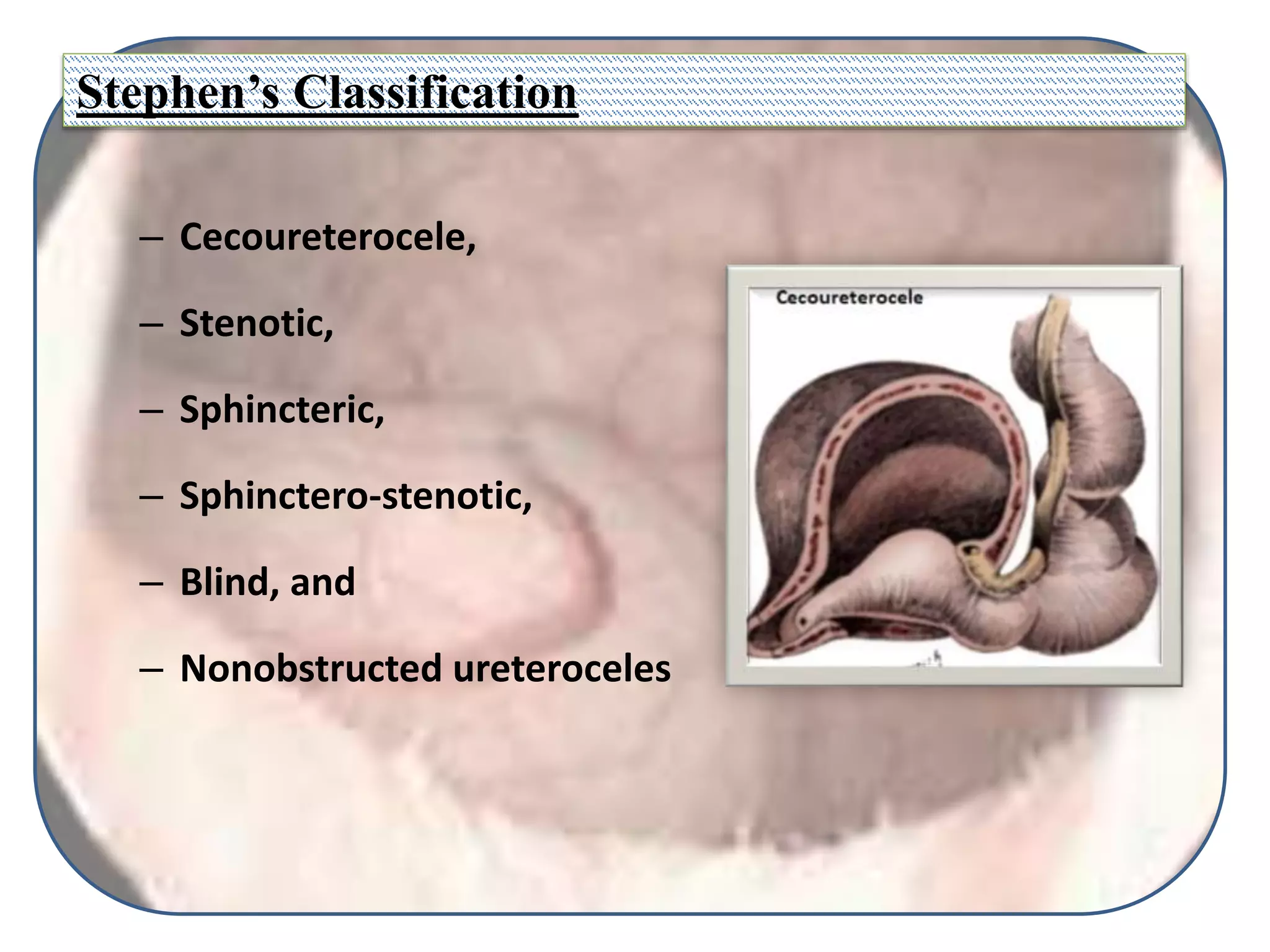 Ureterocele, | PPTX
