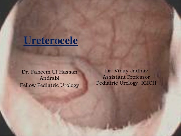 Ureterocele,