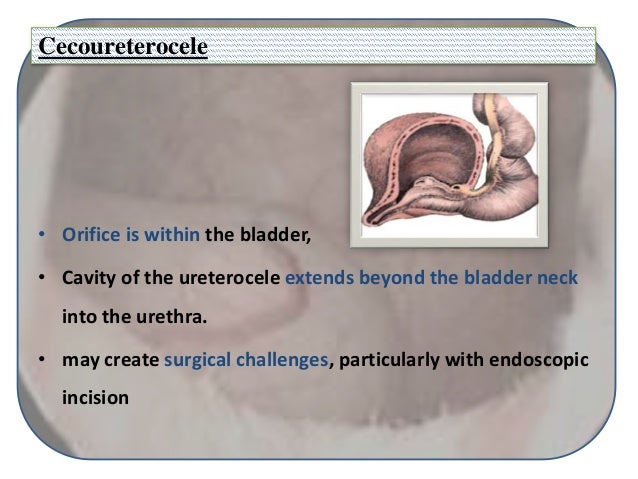Ureterocele,